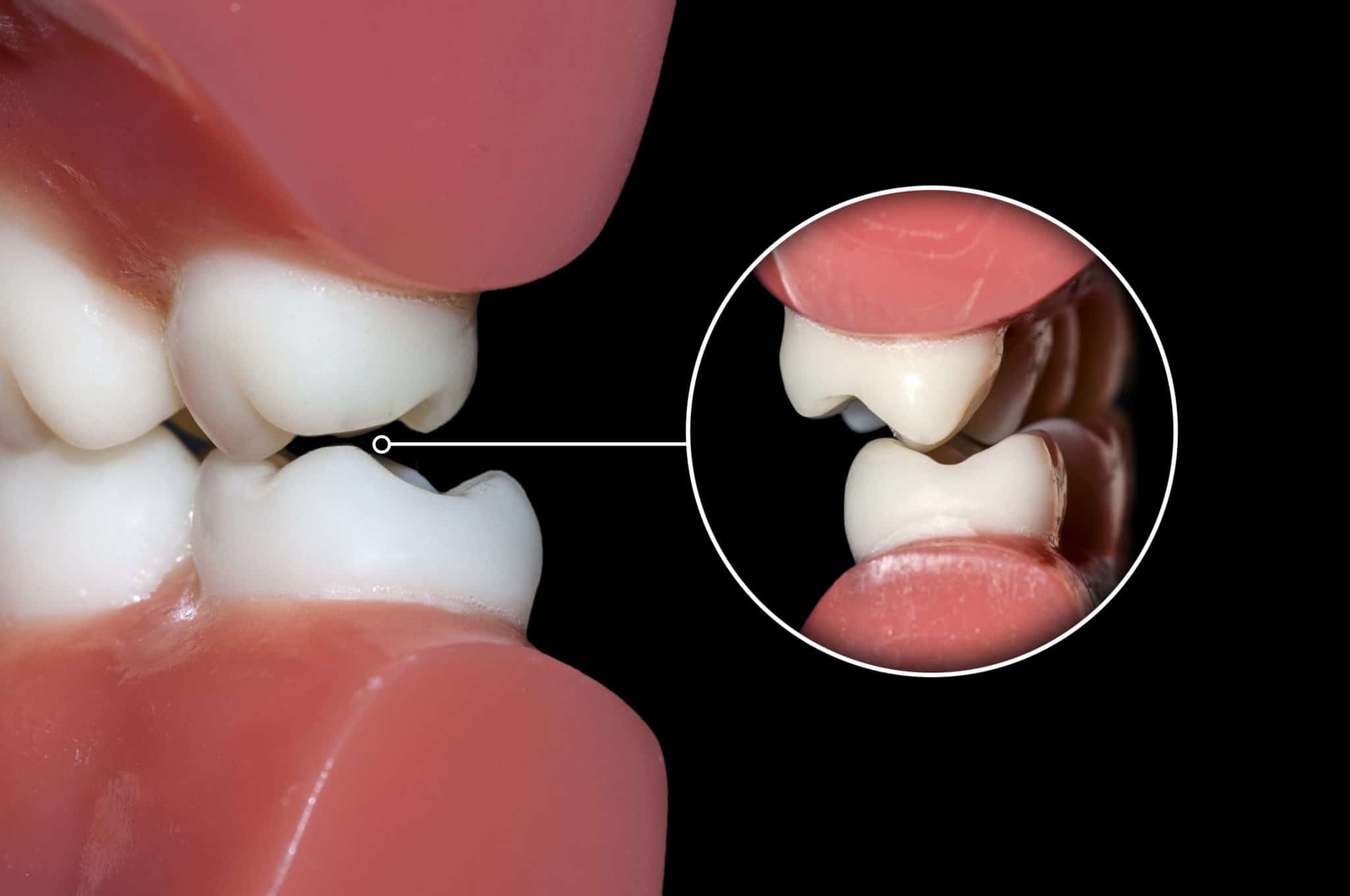 Omaha Dentist Explains How We Improve Bite Function | Omaha, NE