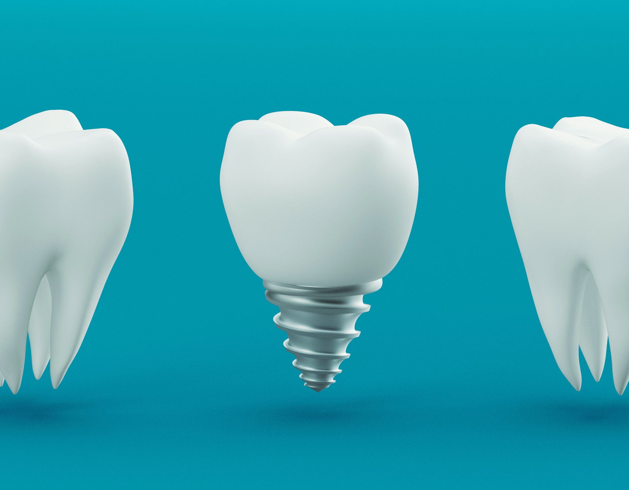 Replacement Roots For Your Tooth | Omaha, NE