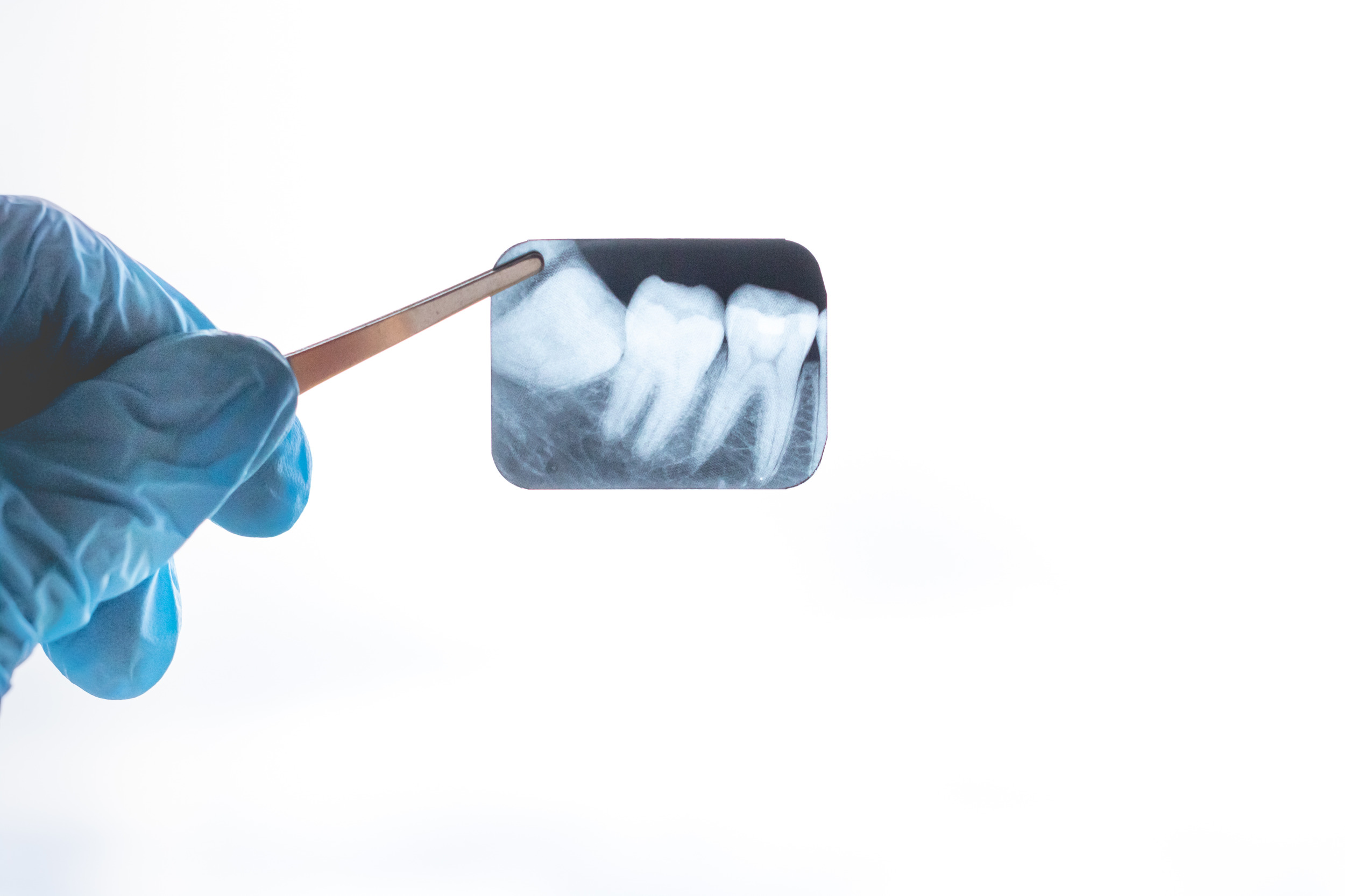 Extracting Wisdom Teeth To Save Your Smile | Omaha, NE